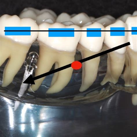 Lateral View Of A Reverse Twin Block Rtb Worn By By A Patient Note