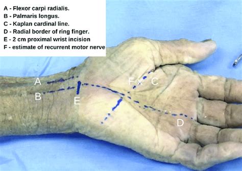 Surface Anatomy Markings Of Safe Zone Download Scientific Diagram
