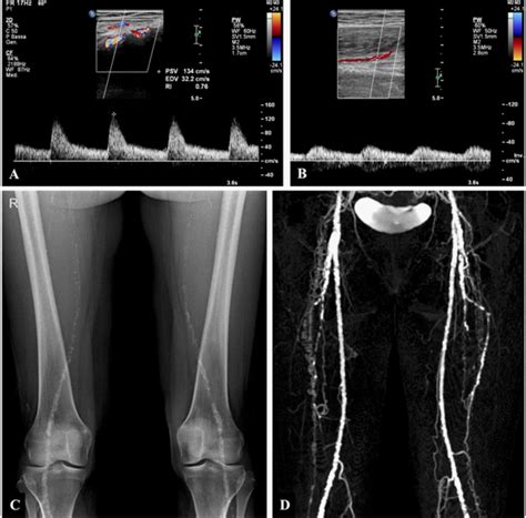 Challenging Arterial Calcification Disease Associated With Rare Nt5e