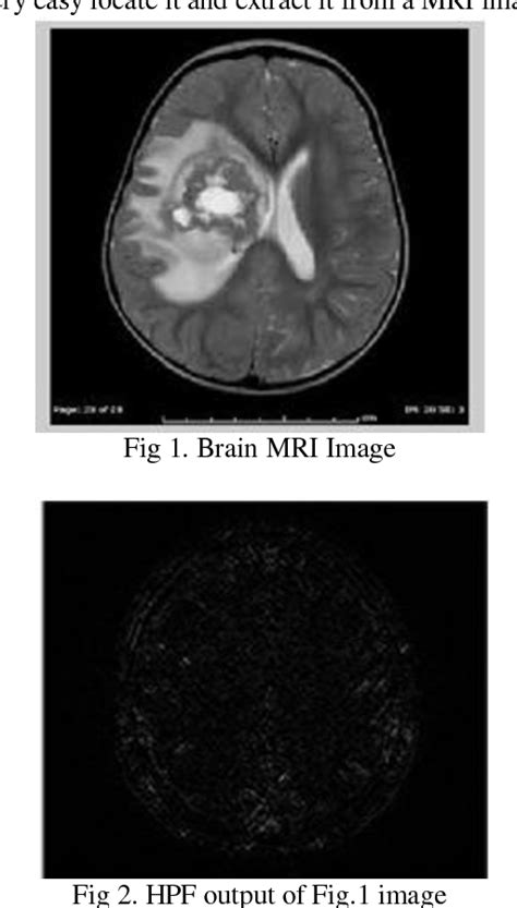 Figure 1 From Brain Tumour Extraction Using Otsu Based Threshold Segmentation Semantic Scholar