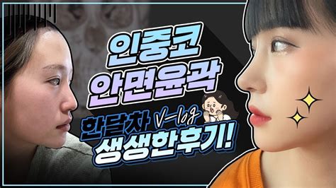 안면윤곽앞턱 사각턱 인중코성형코재수술 한달차 【vlog】 Youtube