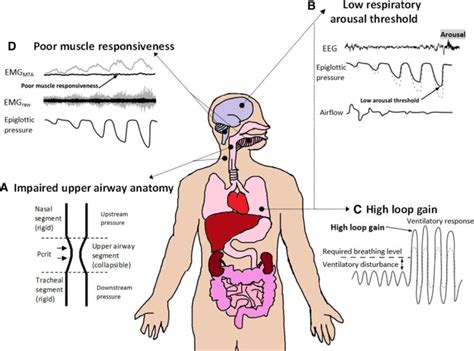 Obstructive Sleep Apnea Pathophysiology OpenAnesthesia