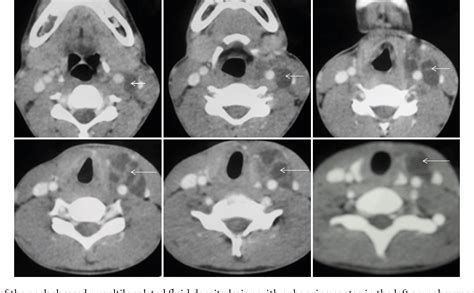 Figure 1 From Cervical Thymic Cyst A Rare Differential Diagnosis In