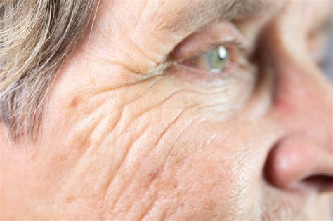 Actinic Keratosis La Dermatology Dermatology