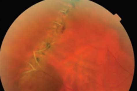 Retina Consultants Surgery Center Lattice Degeneration