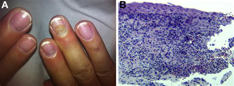 Pyoderma Gangrenosum At A Rare Site In Crohns Disease Clinical