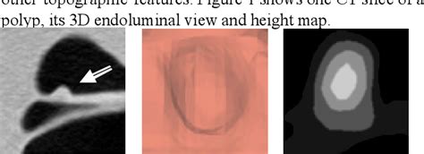 Figure 1 From Ct Colonography Computer Aided Polyp Detection Using Topographical Height Map