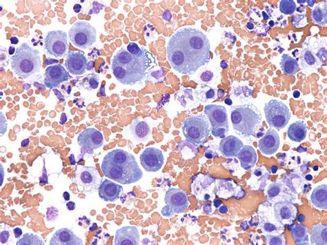 Mesothelial Cells In Pleural Fluid Stock Image Image Of Mesothelial