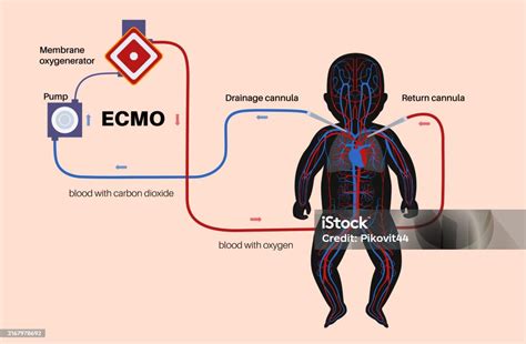 Extracorporeal Membrane Oxygenation Stock Illustration Download Image