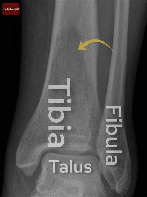 Lytic Bone Metastases The Radiologist