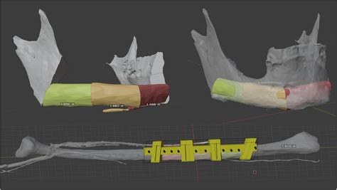 Virtual 3d Planning For A Osteocutaneous Fibula Graft Using A