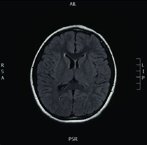 Brain Mri Axial Flair Image Showing Mild Generalized Atrophy
