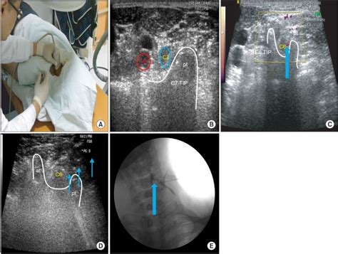 A Ultrasound Guided Selective Nerve Root Block Target Nerve Root