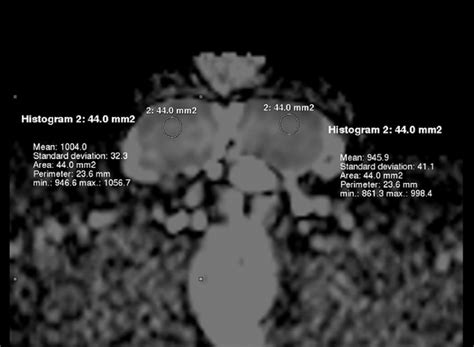 Healthy Volunteer ADC Maps Were Demonstrated ADC Values Were Measured Download Scientific