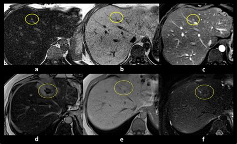 Detection And Treatment Of Liver Metastases Concept Of Cytoreduction Download Scientific