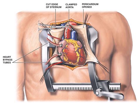 Heart Valve Replacement