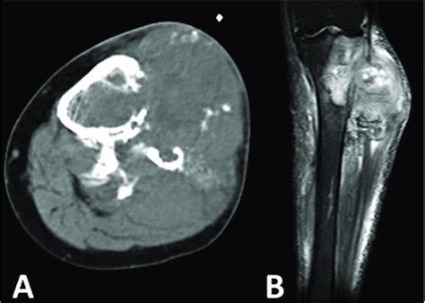 Dedifferentiated Chondrosarcoma Of The Left Proximal Tibia And Fibula Download Scientific