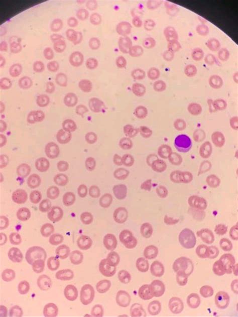 The Rbc Volume Histogram Below Shows A Dimorphic Population Of Rbcs As