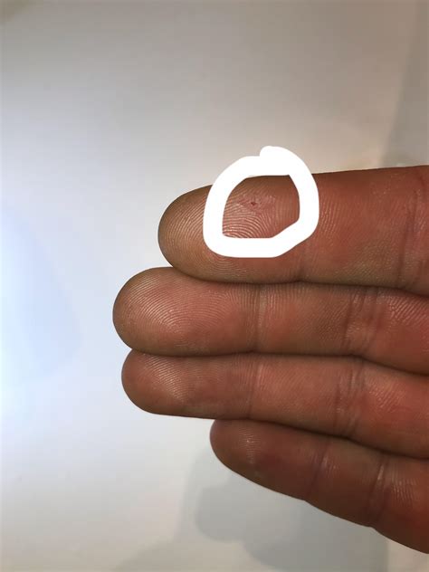 How To Get Metal Splinter Out Of Finger R Fixit