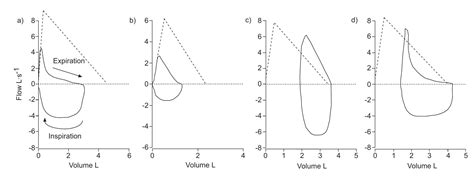 A B Examples Of Obstructive Pulmonary Defects With A Low