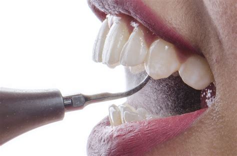 Scaling Polishing Prestige Dental Care My