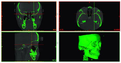 An Initial Segmentation Mask From The Cbct Data Download Scientific Diagram