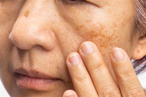 Remedies For Menopause Skin Discoloration Biopelle