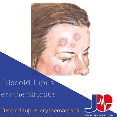 Discoid Lupus Erythematosus