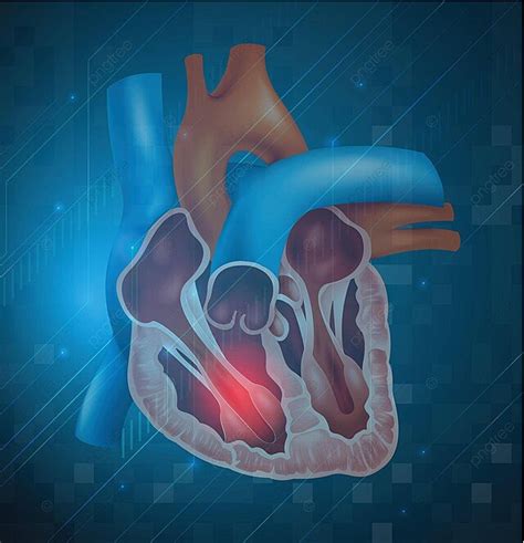 Heart Attack Embolism View Science Vector Embolism View Science Png