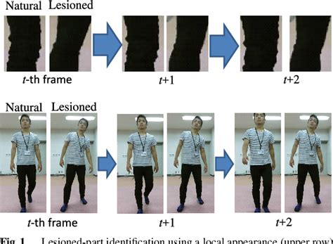 figure 1 from classification of gait anomaly due to lesion using full