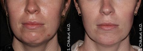 Chin Augmentation Archives Refresh Dermatology