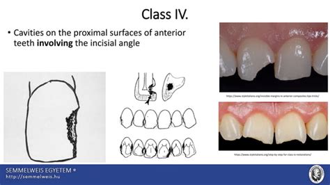 Blacks Cavity Classification For Pit And Fissure Caries Pdf