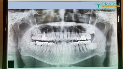Impacted Wisdom Teeth Symptoms