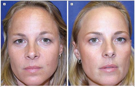 What Are The Effects Of Long Term Botulinum Toxin Injections Dr