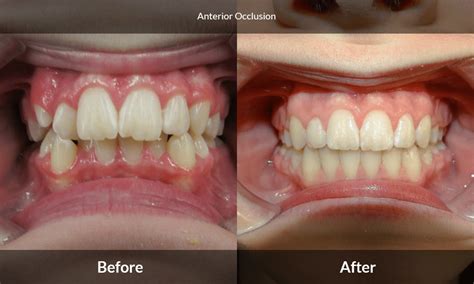 Before And After Photos Of Our Orthodontic Treatment At Portland Braces