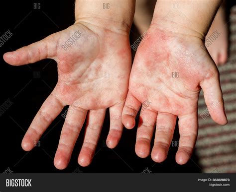 Red Rash On Hands Image And Photo Free Trial Bigstock