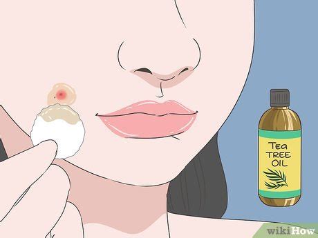 Ways To Get Rid Of A Blind Pimple WikiHow Life