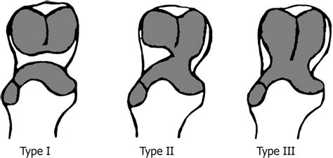 Trochlear Notch