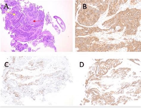 Histopathology From Tissue Sample Obtained At The Time Of Ptc The Download Scientific Diagram