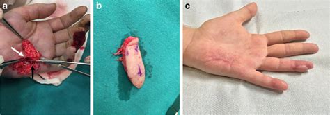 A Left Hand 4th Fingertip Defect Black Arrow Pedicle White Arrow