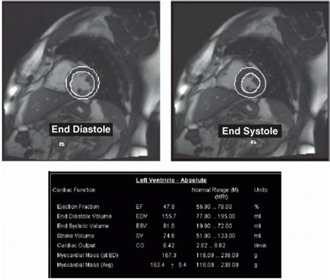 Cardiac Mri Radiology Key