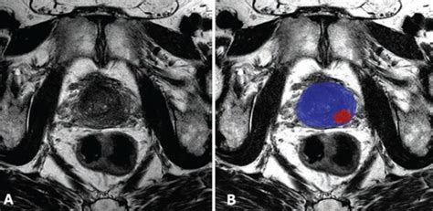 Prostate Ai Improves Biparametric Mri The Imaging Wire