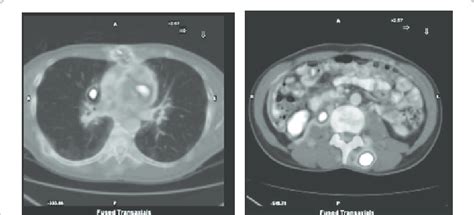 Abnormal Increased Focal Fdg Uptake In Following Multiple Intra Download Scientific Diagram