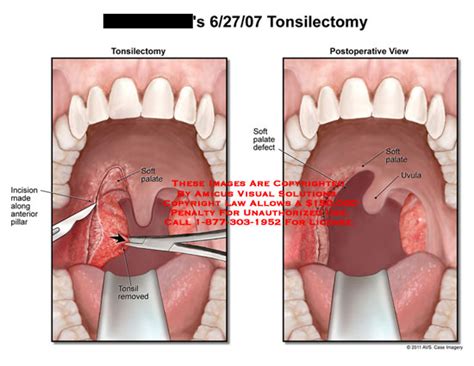 Soft Palate Tonsil