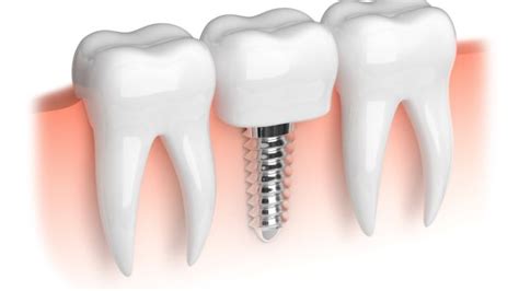 What Role Do Impression Copings Play In Implants Doctors Finder