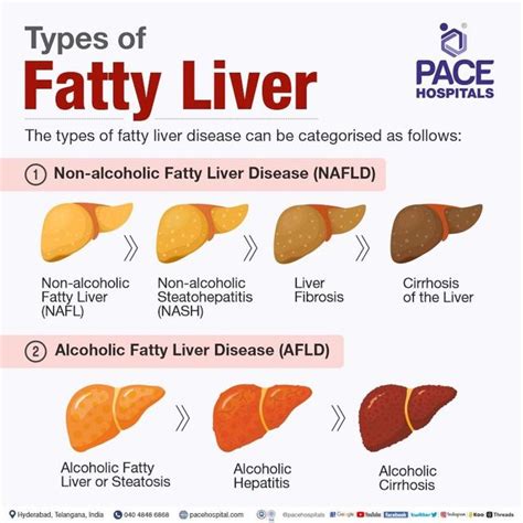 Fatty Liver Disease Nonalcoholic Fatty Liver Disease Um