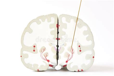 Microelectrode Recording Of Globus Pallidus In Parkinson S Disease