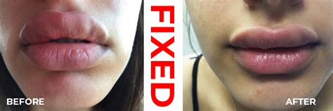 Big Lips With Juvederm Are Not Always Better Lips Orange County Ca