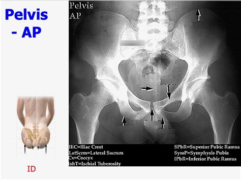 Pelvis Ap Diagram Quizlet