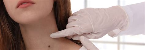 Understanding Skin Moles Moffitt